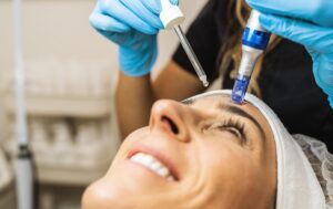 Microneedling vs Chemical Peel: Which Is Right for You?